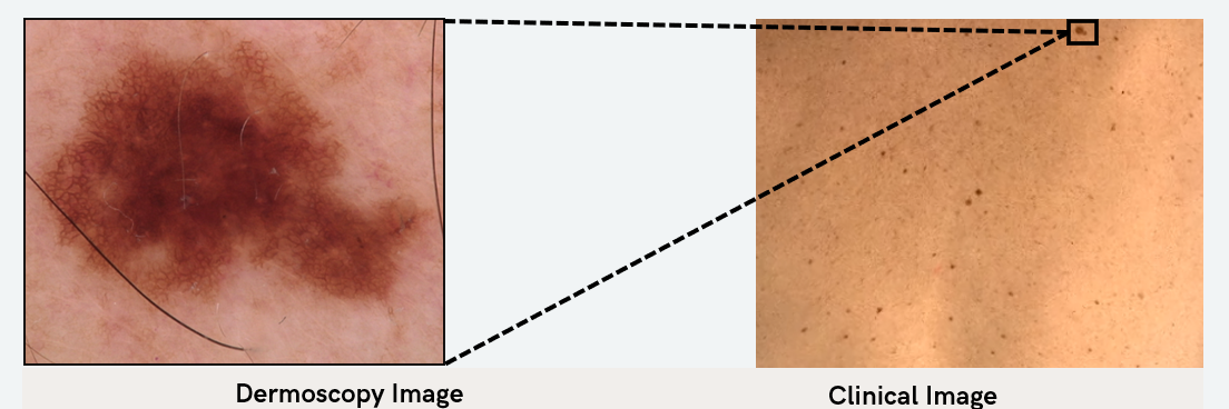 Pigmented-Skin-Lesion-Detection-in-Clinical-Images-Using-Deep-Learning-Methodologies